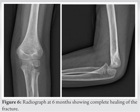Beyond Tradition “figure Of 8” Casting For Gartland Type 1 And Type 2a