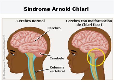 Malformación De Chiari ¿qué Es Y Cómo Prevenirla O Curarla Anunm