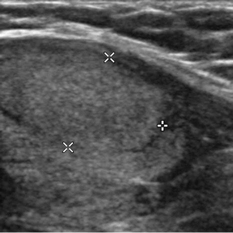 Year Old Woman With Thyroid Nodule Ultrasound Demonstrated A Download Scientific Diagram