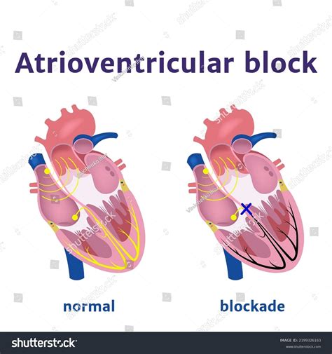 Atrioventricular Block Violation Electrical Signal Heart Stock Vector Royalty Free 2199326163