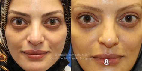 Tepezza Center For Eye And Facial Plastic Surgery