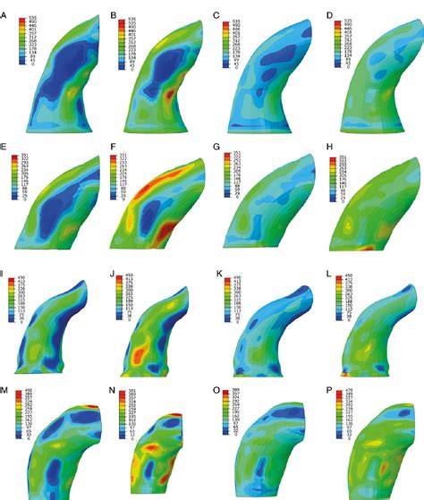 Figure 5 From Ascending Thoracic Aortic Aneurysm Wall Stress Analysis