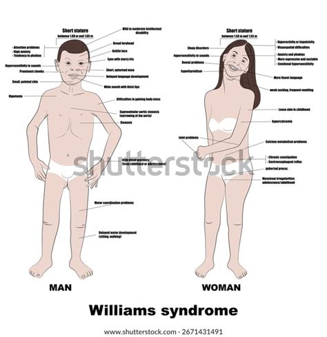 Williams Syndrome Rare Genetic Disorder That Stock Vector Royalty Free