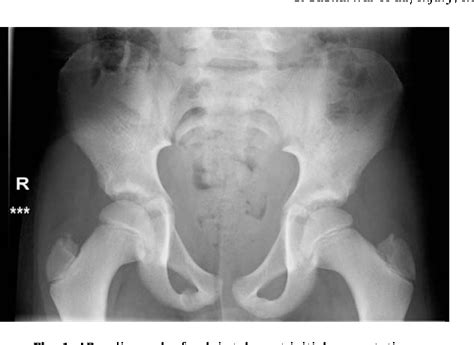 Inferior Pubic Ramus Pelvic And Acetabular Fractures Orthopaedia
