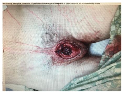 Autoamputation Of Genitalia In Bipolar Patient Pmc