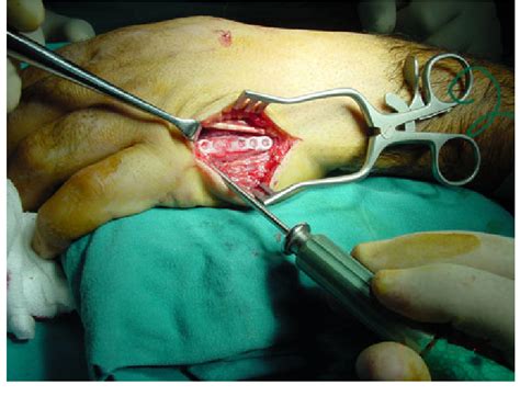 An Intraoperative Photograph Shows Placement Of The Bioabsorbable