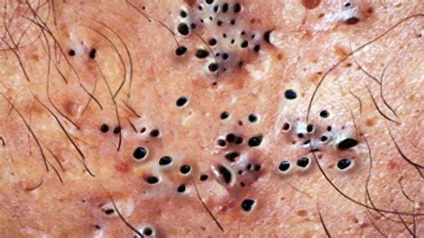 подборка выдавливания прыщей 34 Ii выдавливания прыщей Youtube