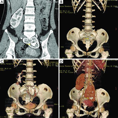 Radiologic Evaluation Using Computed Tomography Urography Ctu Download Scientific Diagram
