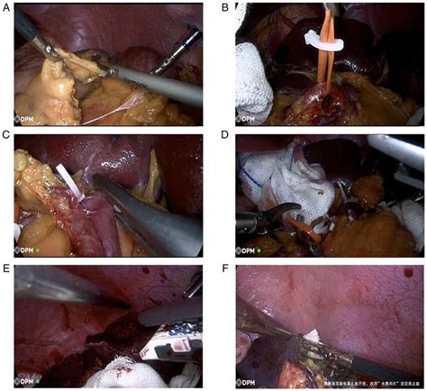 Partial Splenectomy And Stripping Of A Giant 8x9 Cm Splenic Cyst At