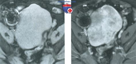 КТ МРТ УЗИ при переходноклеточном раке яичника