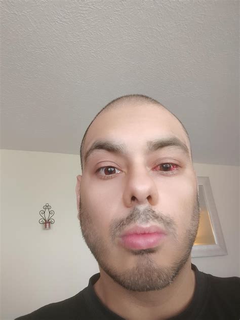 Strabismus Surgery Rstrabismus