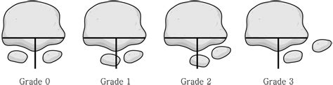 Medial Sesamoid Position In Moderate To Severe Hallux Valgus