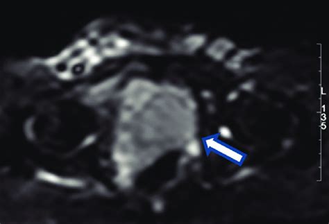 Diffusion Weighted Image Shows High Signal Intensity In Large Prostatic