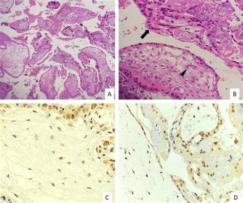 A B Microscopic Examination Of Partial Mole Reveal Two Population Of