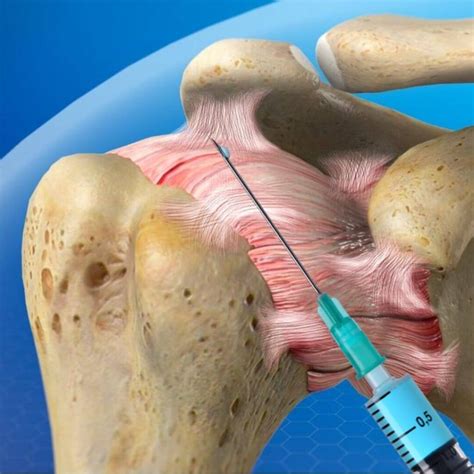 Capsulite Adesiva Ombro Congelado