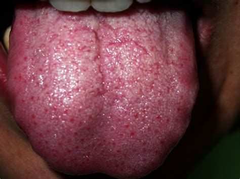 Funorm Papillary Glossitis