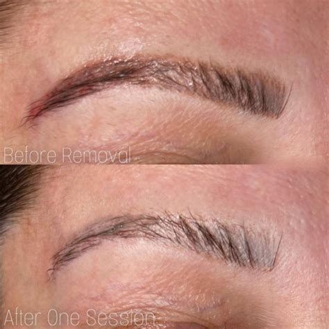 Microblading Removal Saline Laser And Other Techniques
