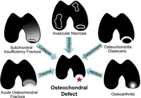 Osteochondral Lesions Of The Knee Chris Hattersley