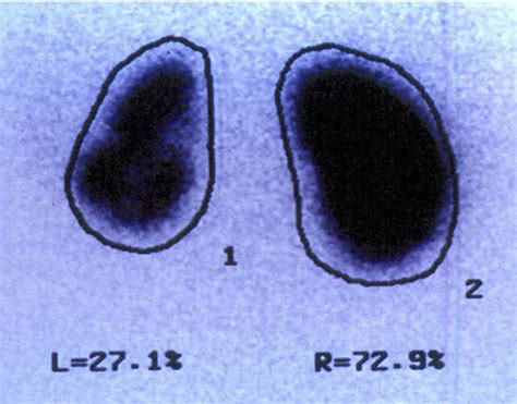 Figure 1 From Reflux Nephropathy Semantic Scholar