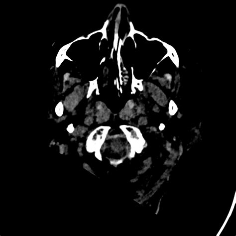 Radiopaedia Case Pca And Cerebellar Artery Infarct Id 19024 Study