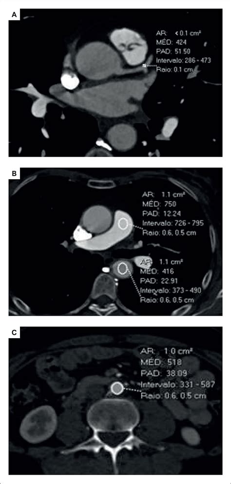 Conventional And Partially Ecg Gated Triple Rule Out Computed Tomography Angiography With