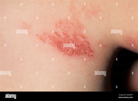 Shingles Rash On Neck Only