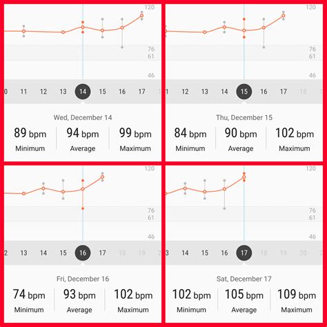 Rarely Defined Sinus Node Modification Ablation Done