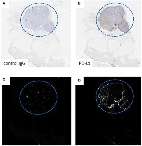 Figure 1 From Digital Quantification Of Tumor Pd L1 Predicts Outcome Of Pd 1 Based Immune