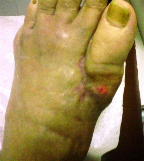 Left Foot Tophi Resolved Goutpal Gout Help