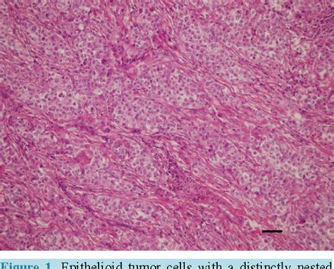 Figure 1 From Malignant Extragastrointestinal Neuroectodermal Tumor