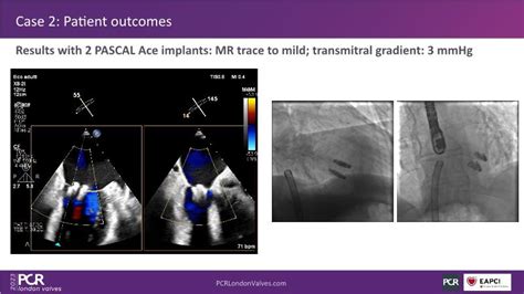 Advancing Valve Repair Mastering Diverse Mitral And Tricuspid Regurgitation Anatomies With The
