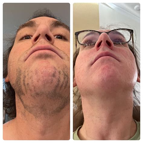 Laser Hair Removal Progress Rtranslater
