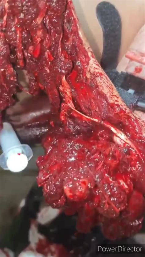 Consequences Of Kamikaze Fpv Drone Explosion LiveGore Com