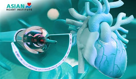 Angioplasty Vs Bypass Surgery Asian Heart Institute