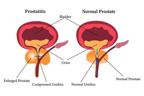 Comparation Of Health Prostate And Unhealth Prostate Prostatitis