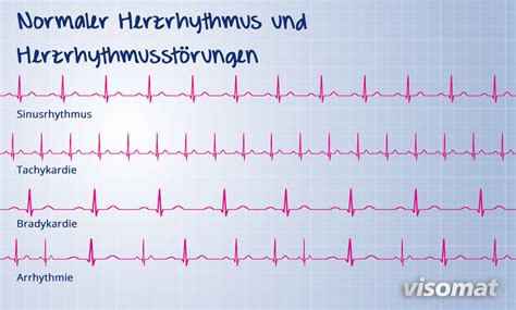 Ekg Aufzeichnung 24 Stunden Ekg Herz Praxis 24 Stunden Ekg Bei Einem