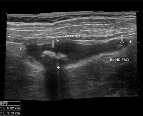 Appendicolith Ultrasound