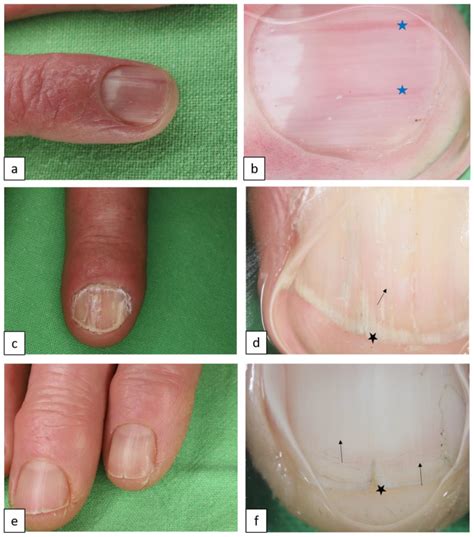 Dermoscopic Patterns Of Genodermatoses A Comprehensive Analysis Pmc