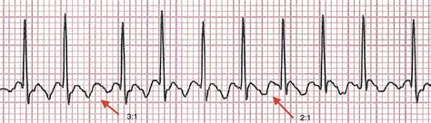 Neonatal Atrial Flutter After Insertion Of An Intracardiac Umbilical