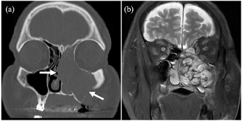 A Non Contrast Ct Of The Sinuses Revealed A Mass With Heterogeneous Download Scientific