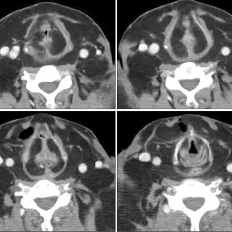Pdf A Case Of Multiple Symmetrical Lipomatosis Causing Upper Airway
