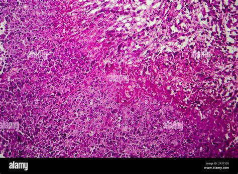 Caseation Of Human Tuberculosis Granuloma Light Micrograph Photo Under Microscope Caseous