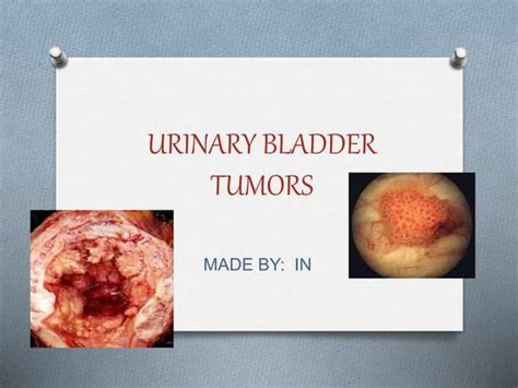 Small Cell Carcinoma Of The Bladder Ppt