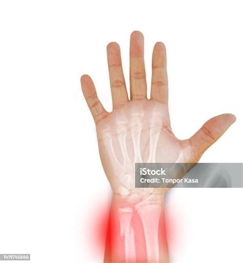 Photo Libre De Droit De Radiographie De La Main Et Du Poignet Vue