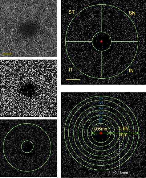 Retinal Microvascular Network And Microcirculation Assessments In High Myopia Pmc