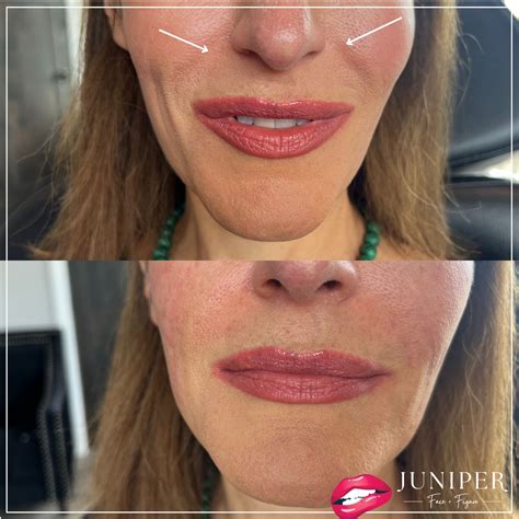 Pyriform Fossa 3 Juniper Face Figure