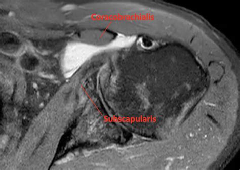 Subcoracoid Bursitis Wikism Sports Medicine Wiki