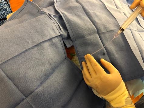 Adnan Qureshi On Linkedin Right Phrenic Nerve Block For Intractable Hiccups Post Ischemic Stroke…