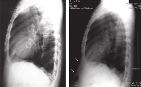 Preoperative X Rays A At The Time Of Discharge After The Initial Download Scientific Diagram Preoperative X Rays A At The Time Of Discharge After The Initial Download Scientific Diagram