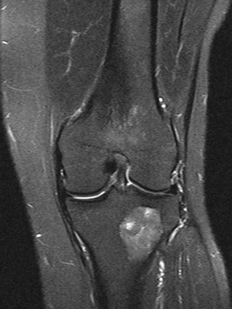 Intraossäres Lipom Der Tibia Pacs